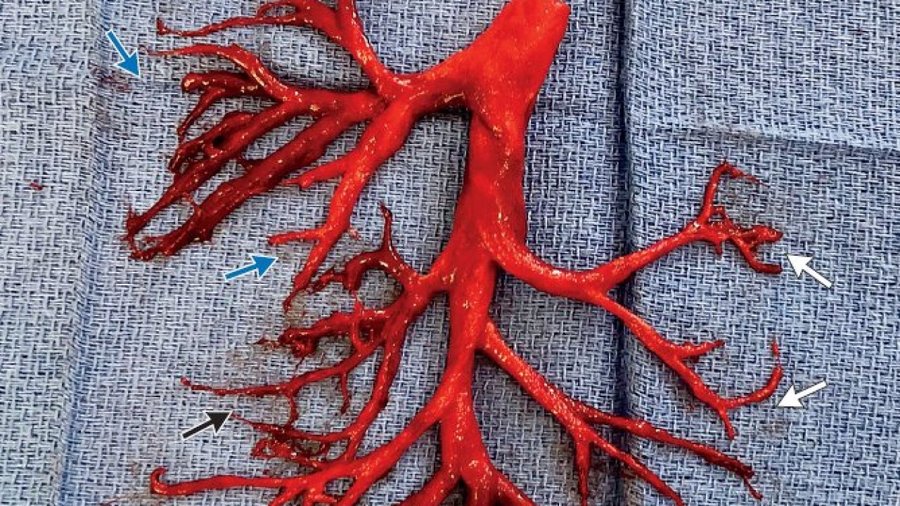 Man coughs up astonishing blood clot shaped like a bronchial tree ...